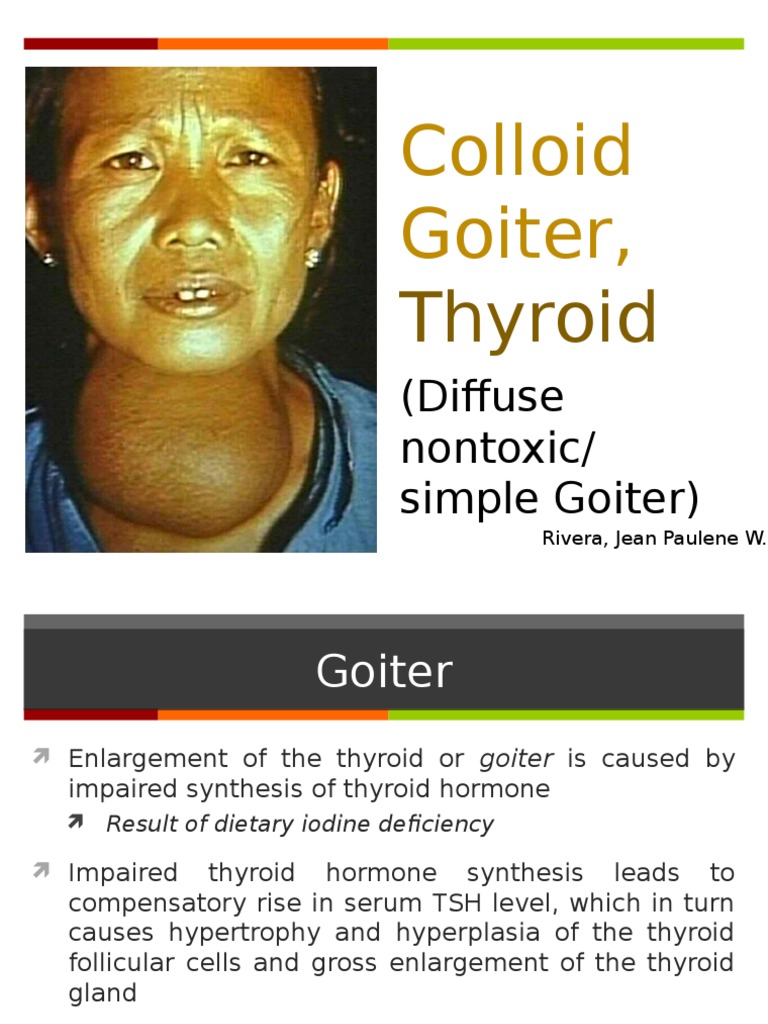 (PATHO A) Colloid Goiter | PDF | Thyroid | Epithelium