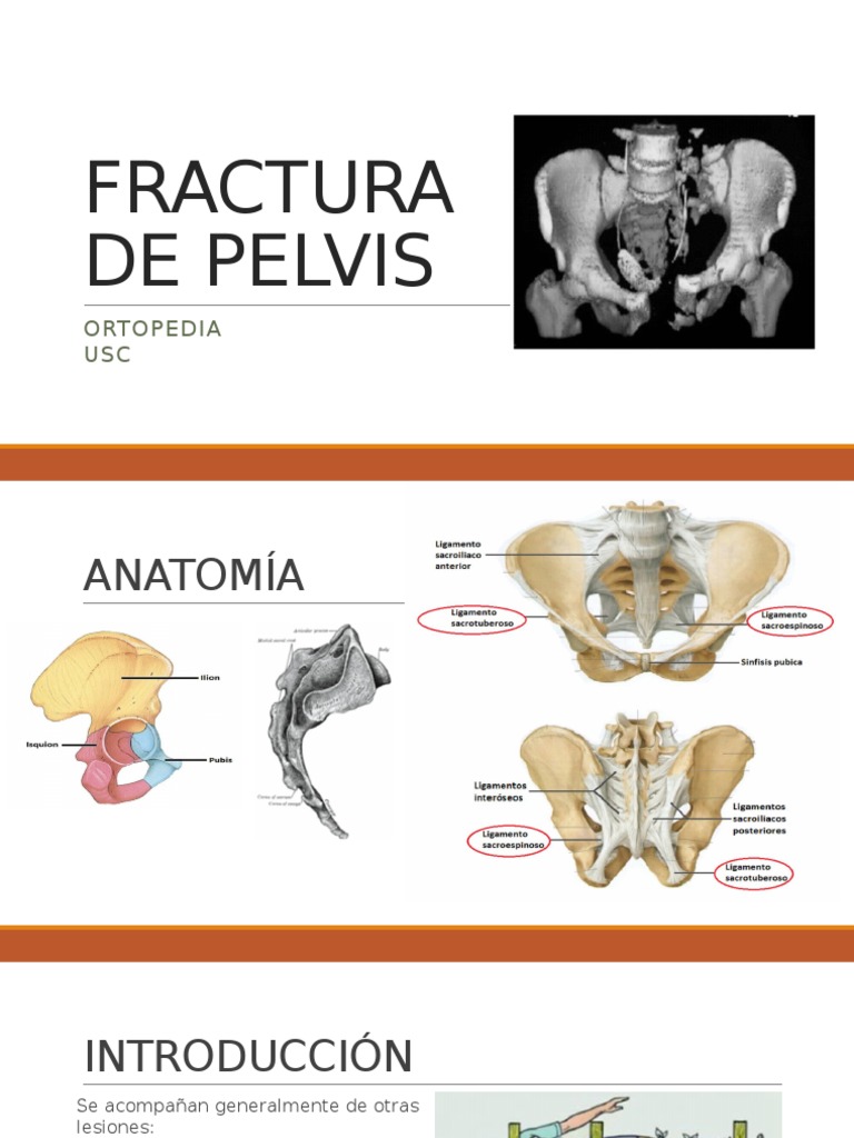 Fractura de Pelvis | PDF | Pelvis | Cadera