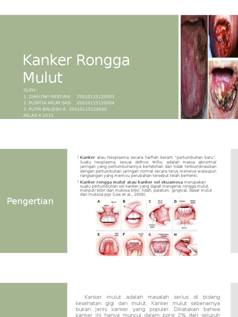 Kanker Rongga Mulut | PDF