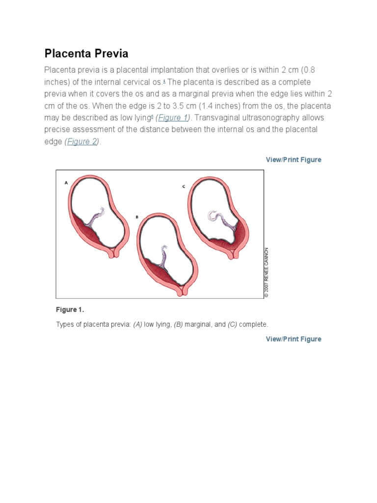 Placenta Previa | PDF | Preterm Birth | Pregnancy