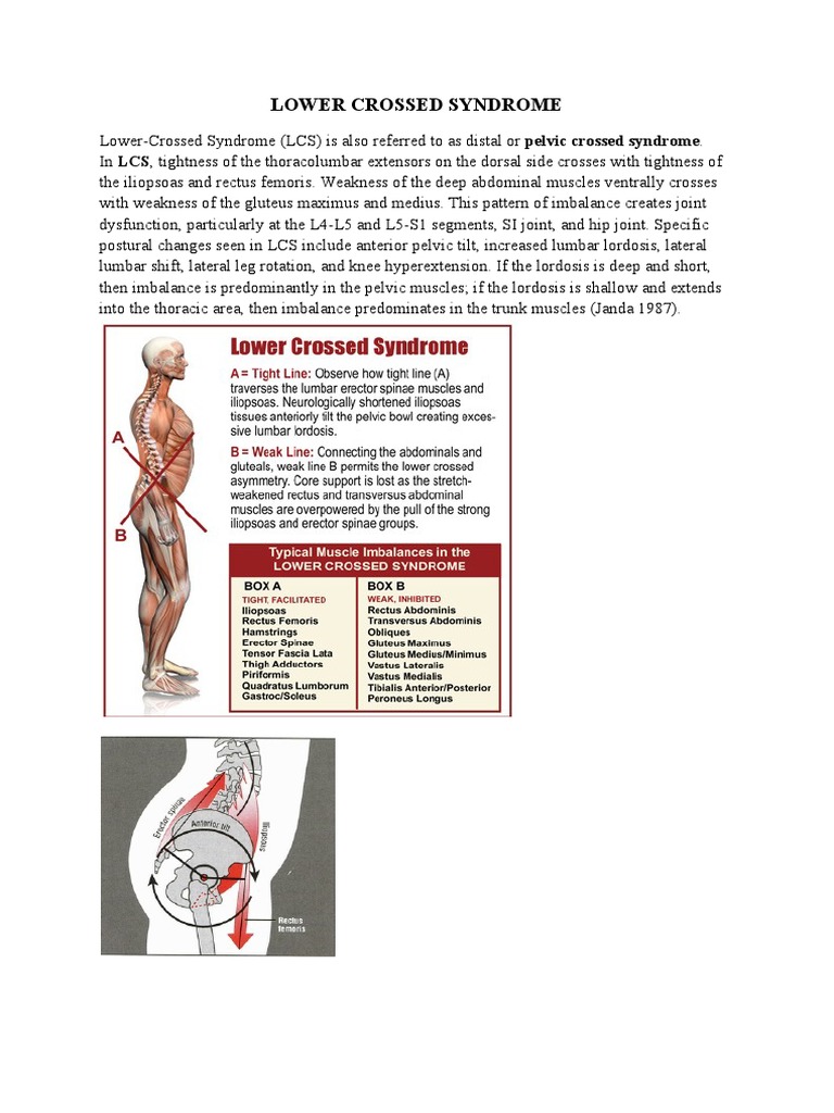Lower Crossed Syndrome | PDF | Pelvis | Hip