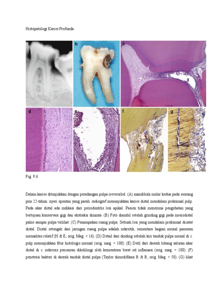 Histopatologi Karies Profunda | PDF