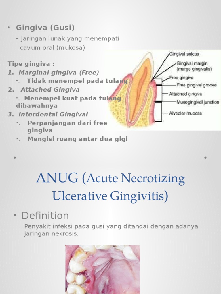 ANUG (Acute Necrotizing Ulcerative Gingivitis) | PDF