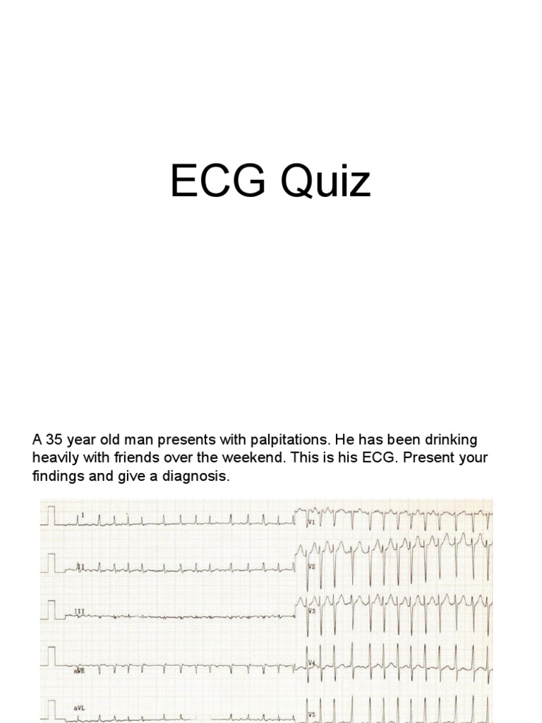 ECG Identification Quiz | PDF | Thorax | Symptoms And Signs