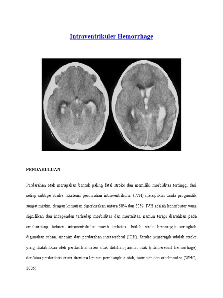 Intraventrikuler Hemorrhage | PDF