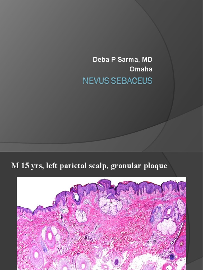Nevus Sebaceus. M 15 Yrs, Scalp. | PDF | Pathology | Anatomy