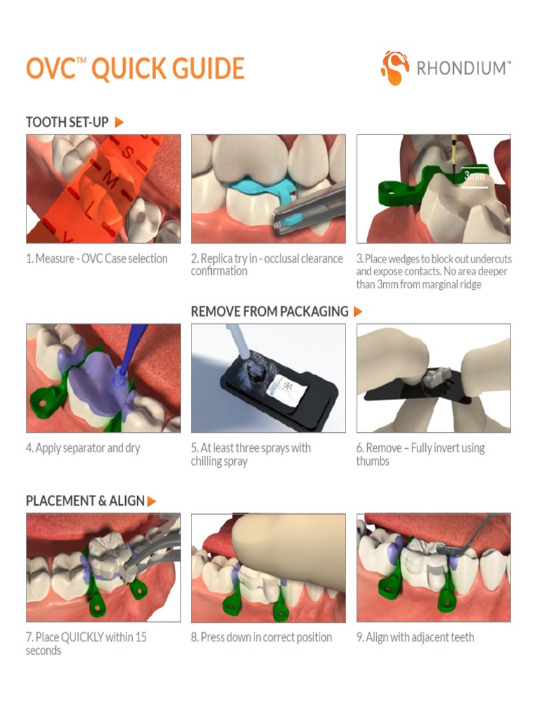 OVC Quick Guide: Tooth Set-Up | PDF