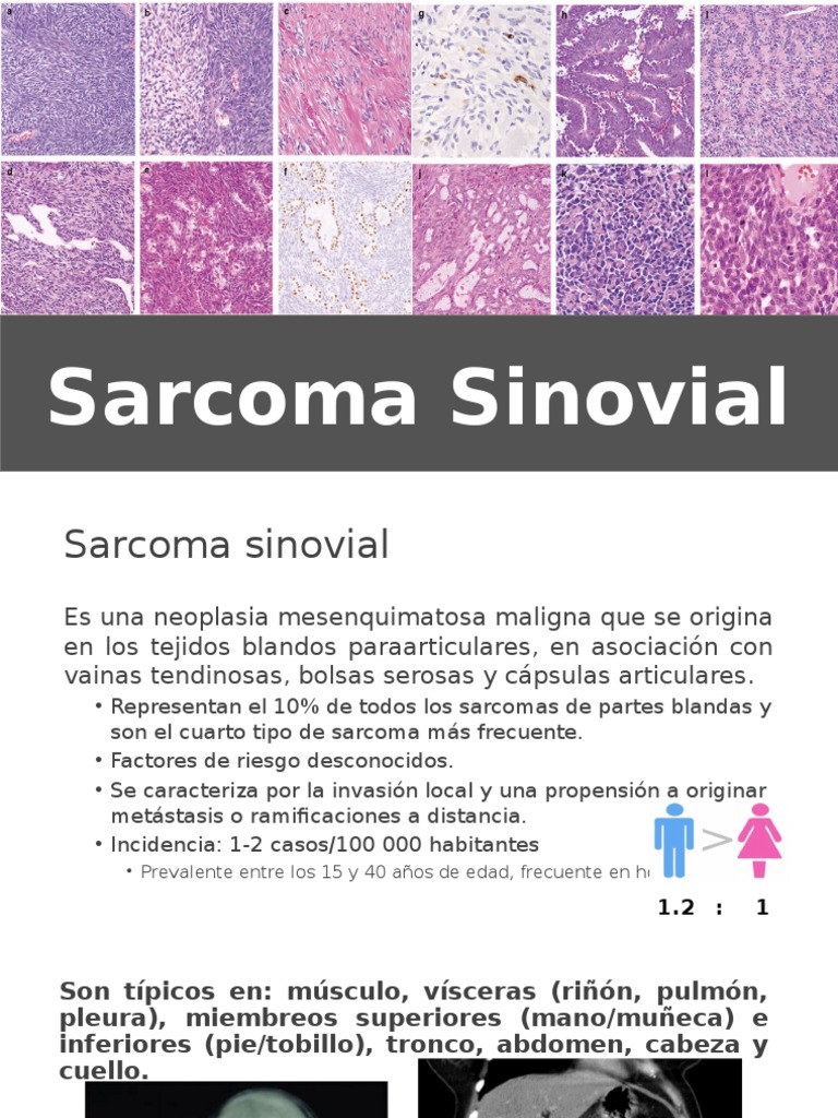 Sarcoma Sinovial.pptx | Sarcoma | Neoplasias