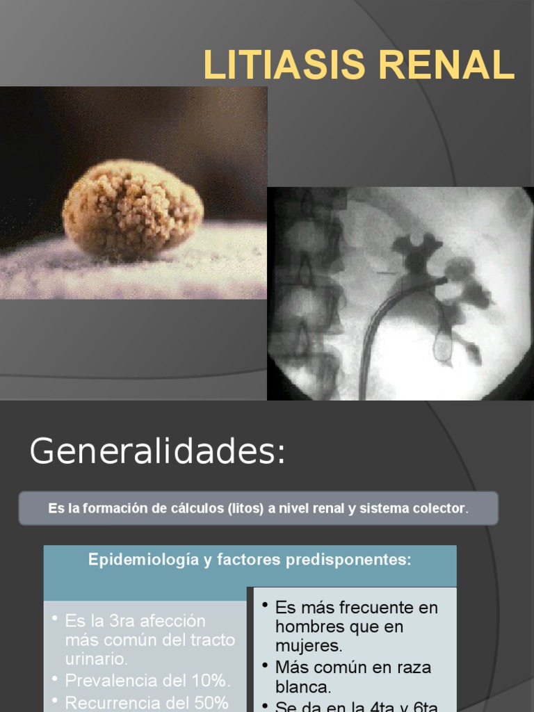 Litiasis Renal Ppt | Enfermedades y trastornos | Medicina | Prueba ...