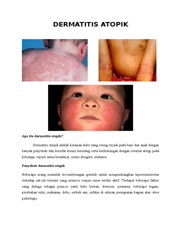 Dermatitis Atopik | PDF