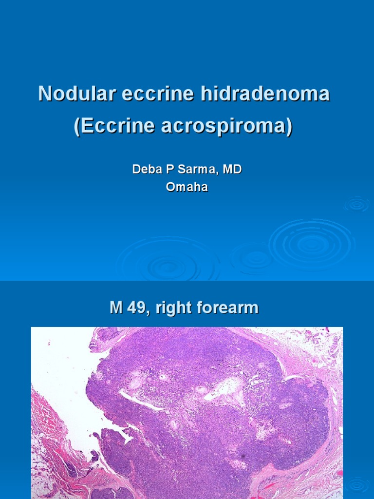 Nodular Eccrine Hidradenoma (Eccrine Acrospiroma) - M 49, Right Forearm ...