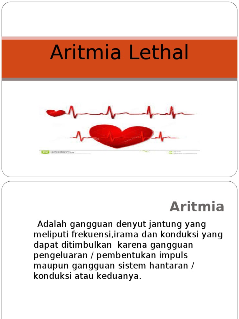 Aritmia Lethal | PDF
