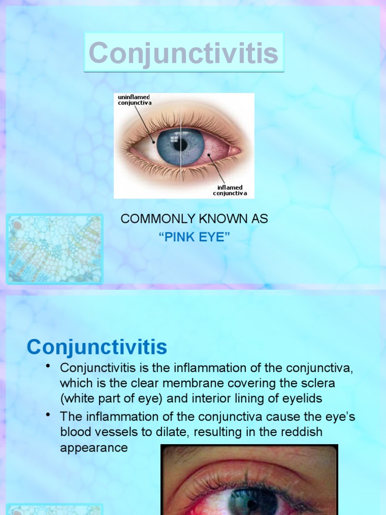 Conjuctivitis | PDF