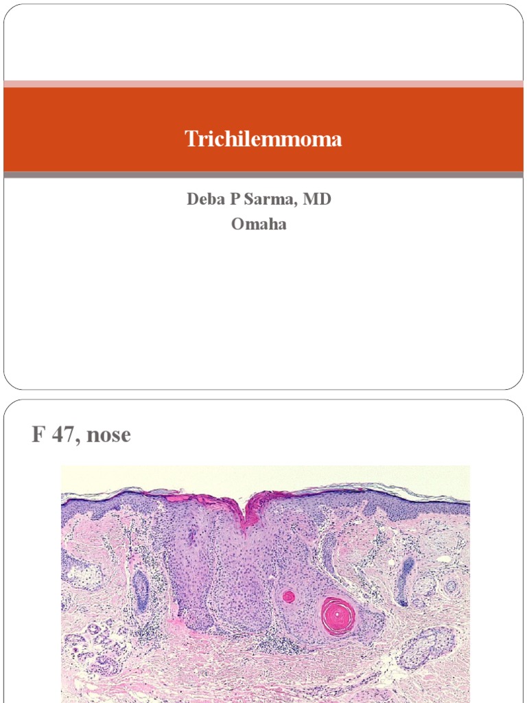 Trichilemmoma Case Study: 47-Year-Old Female | PDF