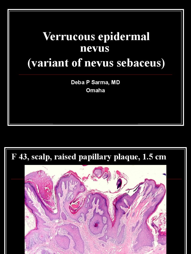 Verrucous Epidermal Nevus. F 43, Scalp. | PDF