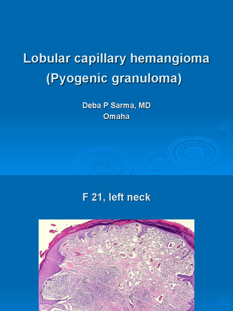 Lobular Capillary Hemangioma (Pyogenic Granuloma) - F 21, Neck. | PDF