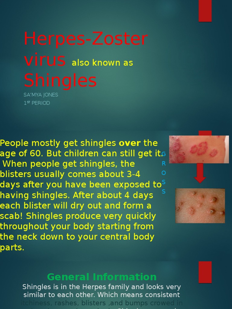 Shingles | PDF | Immunology | Medical Specialties