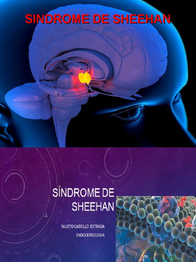 Sindrome de Sheehan | PDF | Hormona adrenocorticotrópica | Glándula ...