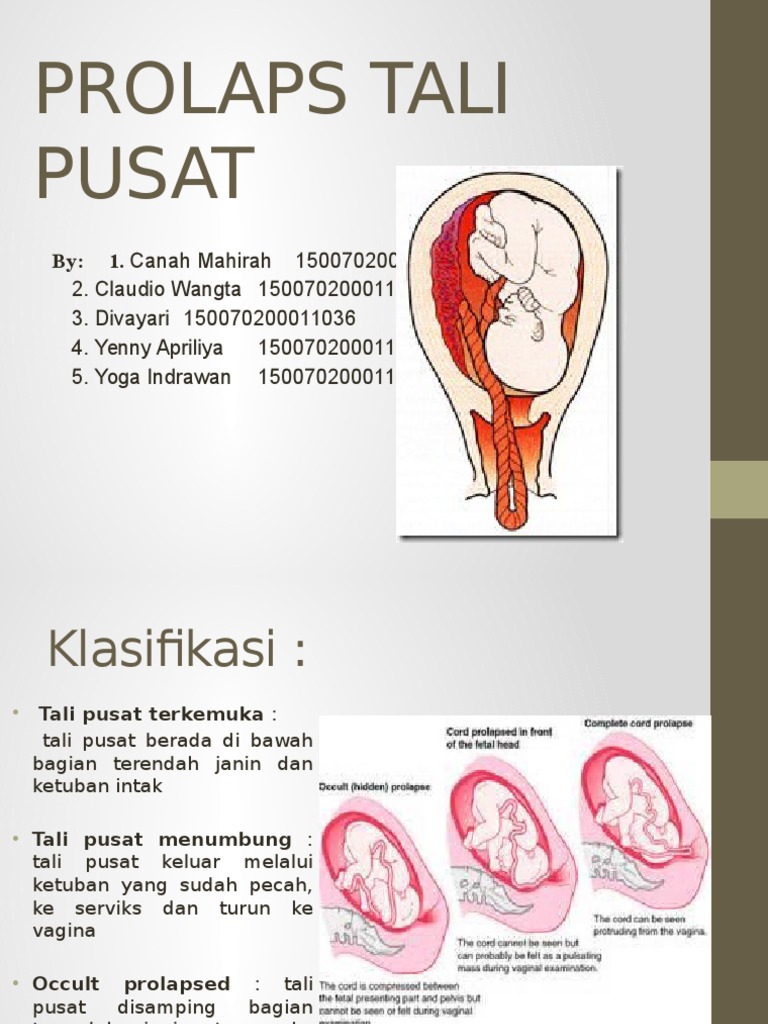 Prolaps Tali Pusat-Bedah Buku | PDF