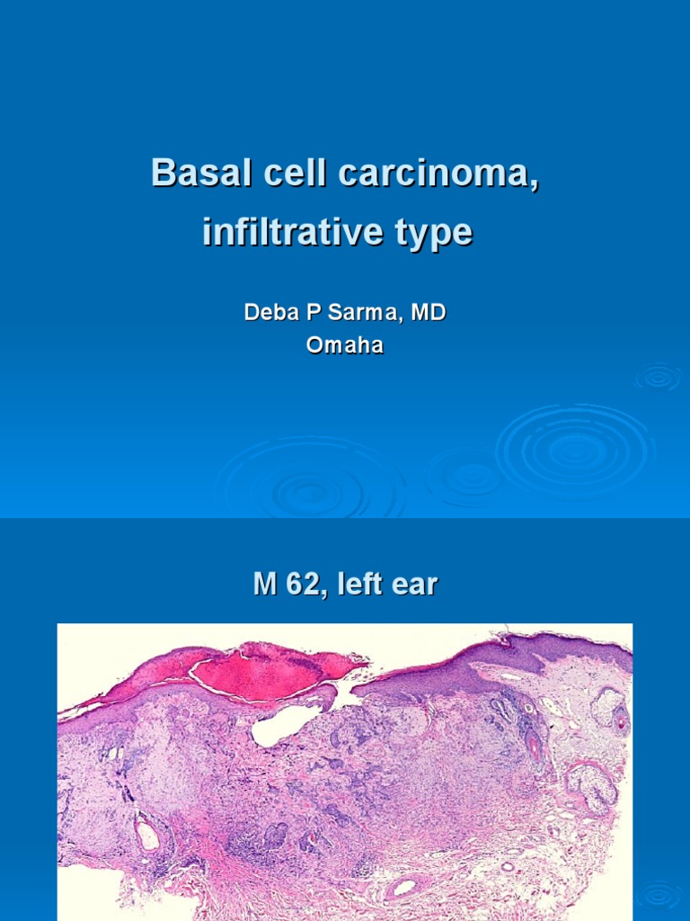 Basal Cell Carcinoma, Infiltrative Type. M 62, Left Ear. | PDF