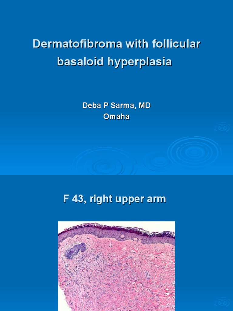 Dermatofibroma With Follicular Basaloid Hyperplasia - F 43, Right Arm ...