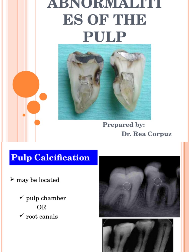 Types and Features of Pulp Calcification | PDF | Human Tooth | Mouth