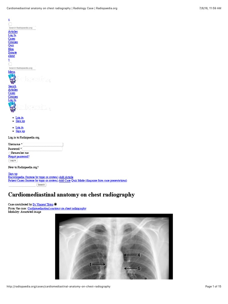Cardiomediastinal anatomy on chest radiography | Radiology Case ...