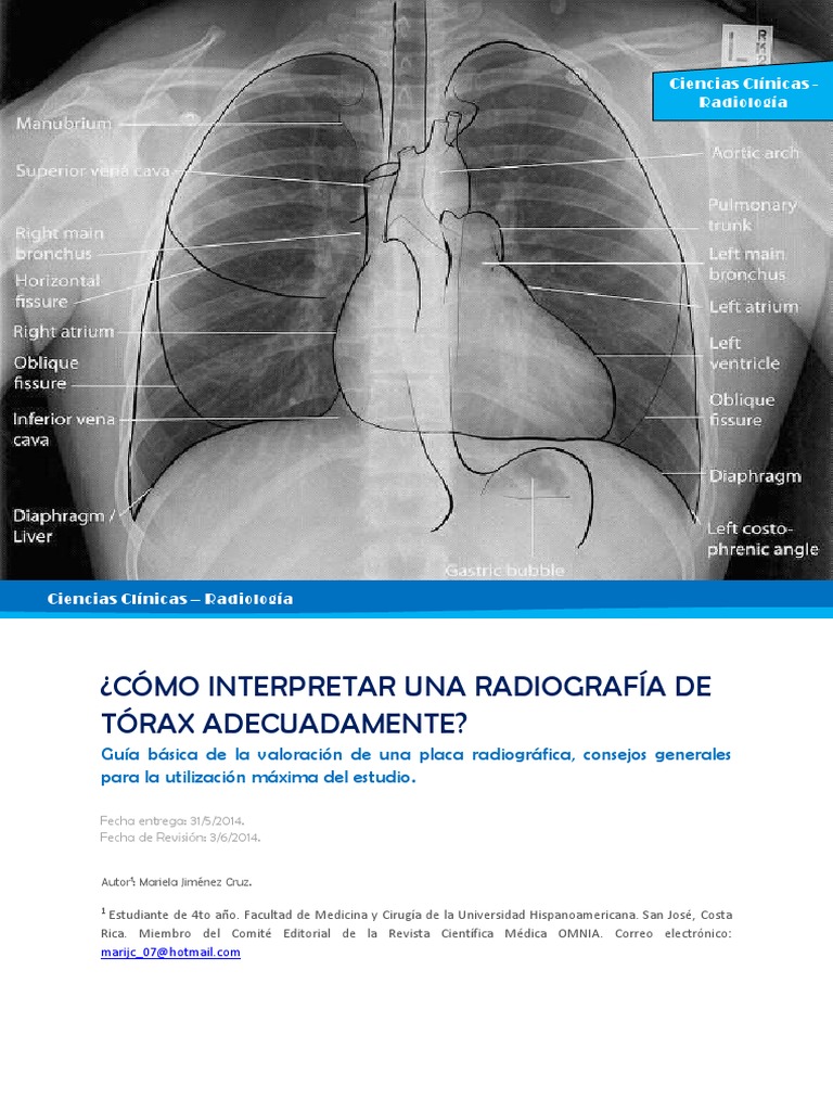 Interpretación RX Tórax | PDF | Rayo X | Radiografía