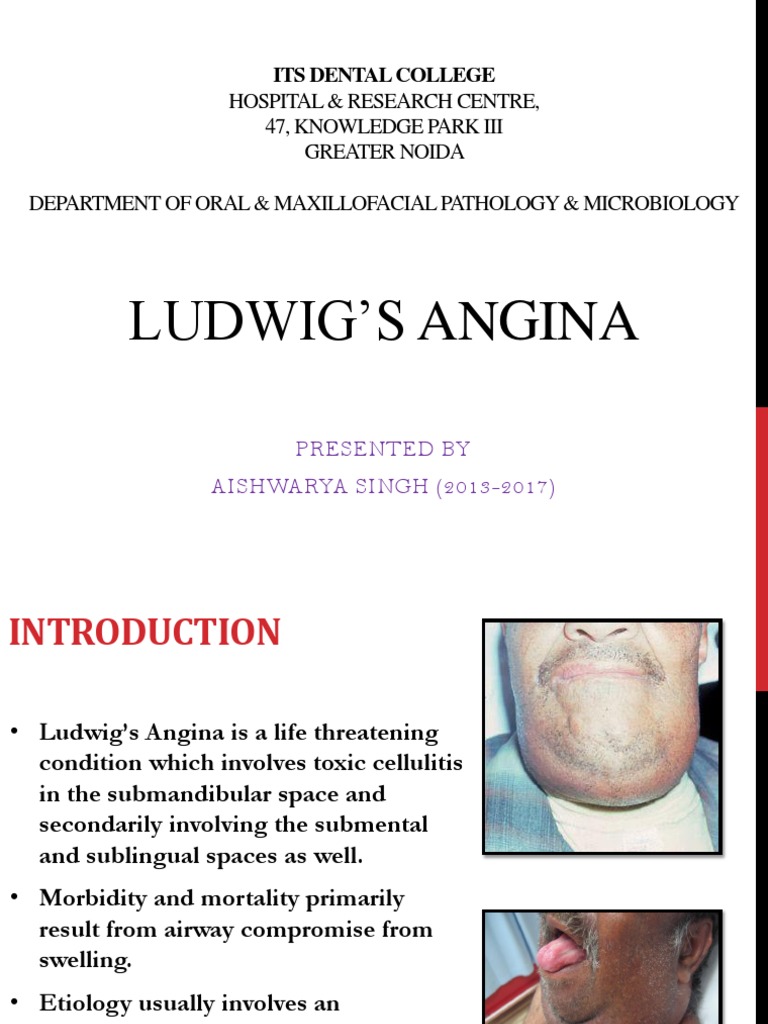 Ludwig's Angina | PDF | Medical Specialties | Clinical Medicine