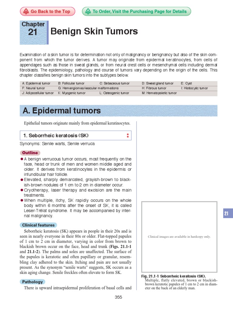 21 Benign Skin Tumors | PDF | Benign Tumor | Neoplasms