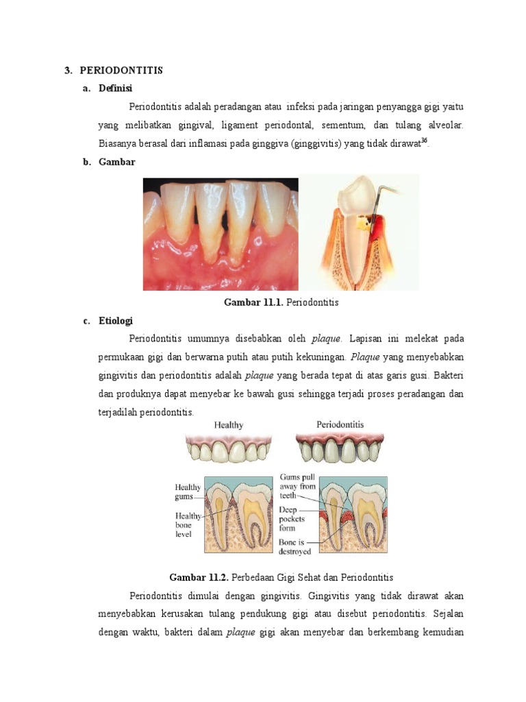 Periodontitis | PDF