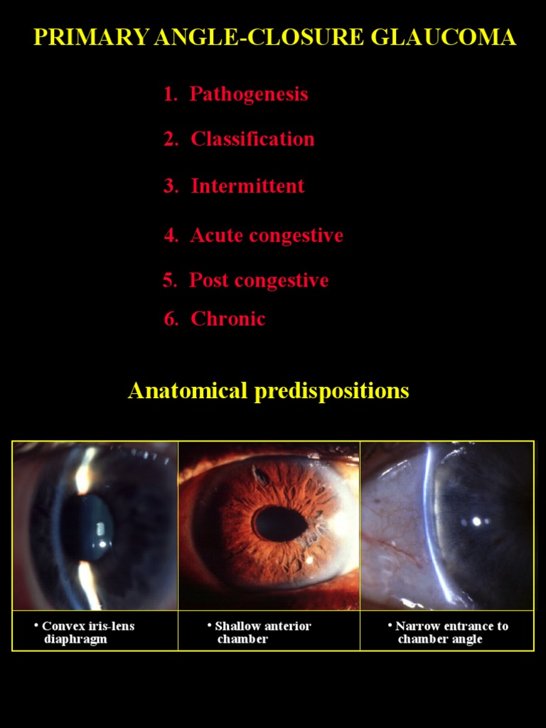 Primary Angle-Closure Glaucoma: 1. Pathogenesis 2. Classification | PDF