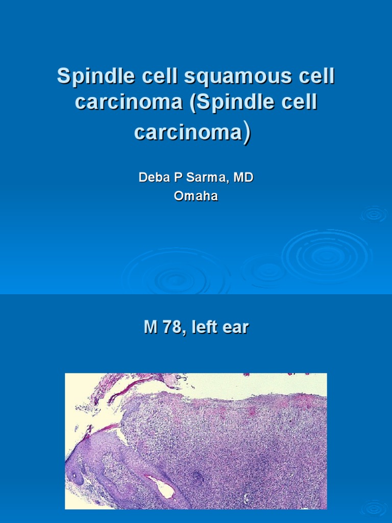 Spindle Cell Squamous Cell Carcinoma - M 78, Left Ear. | PDF | Science ...