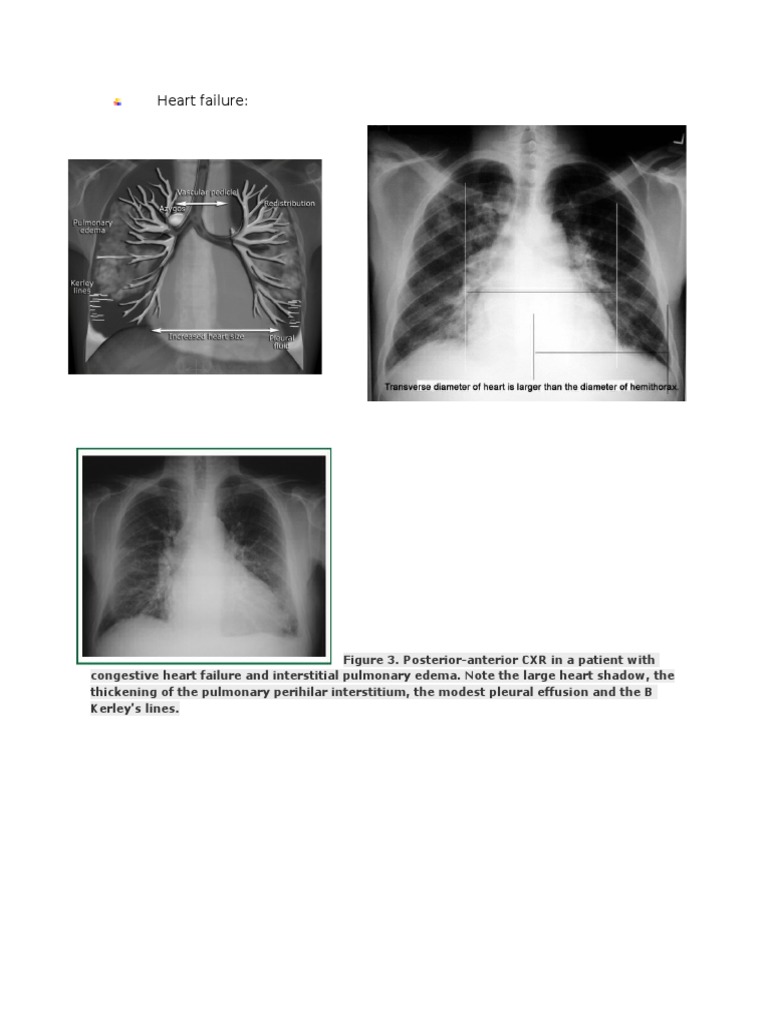Heart Failure and Cardiac Conditions CXR Analysis | PDF