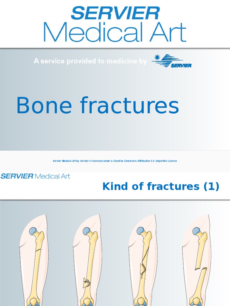 Bone Fractures: A Service Provided To Medicine by A Service Provided To ...
