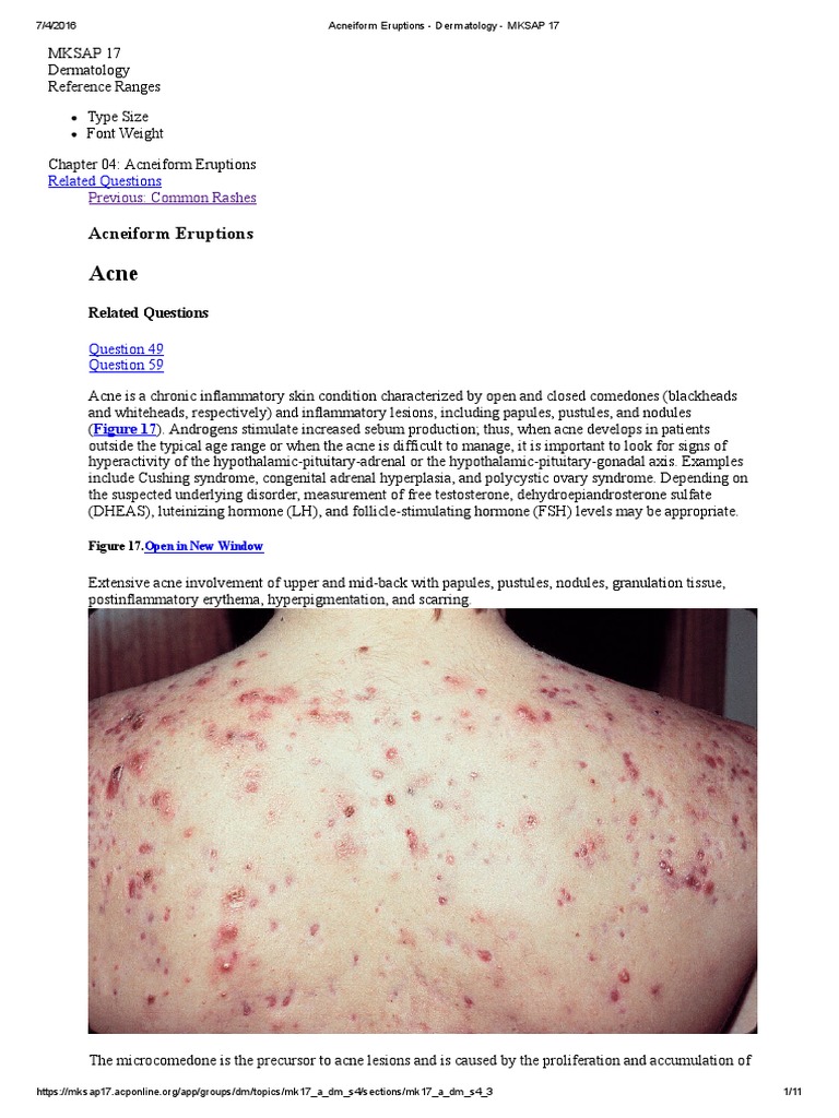 Acneiform Eruptions - Dermatology - MKSAP 17 | PDF | Acne Vulgaris ...