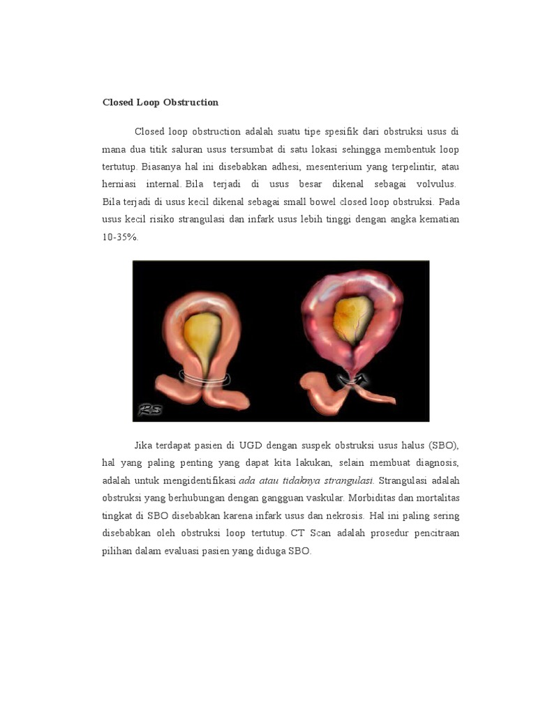 Closed Loop Obstruction | PDF