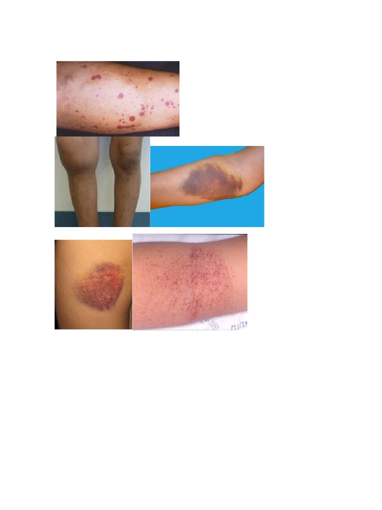 Perbedaan Ekimosis Petekie Dan Purpura | PDF