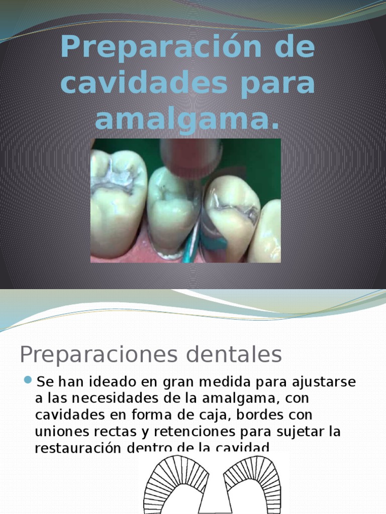 Preparación de Cavidades Para Amalgama