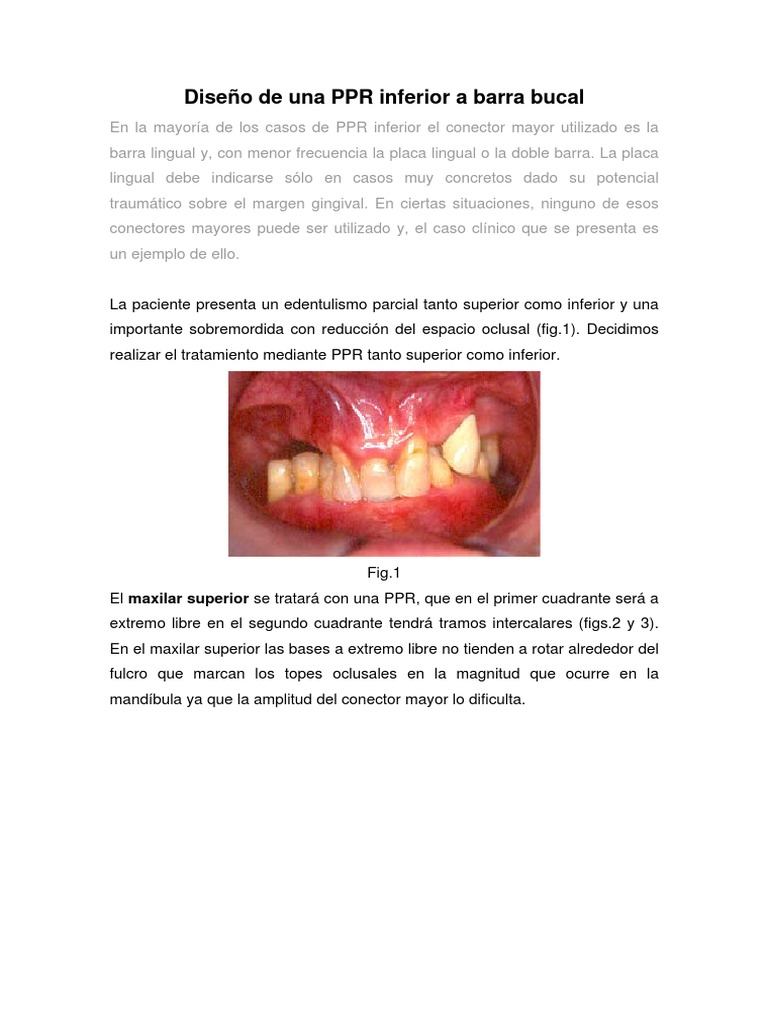 Diseño de Una PPR Inferior A Barra Bucal | PDF | Dentadura postiza | Diente