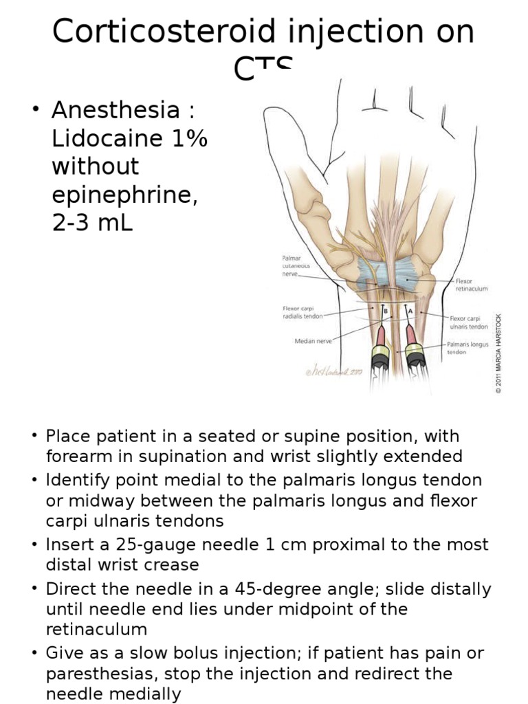 Corticosteroid Injection On CTS | PDF