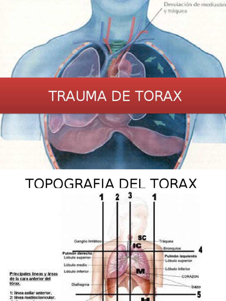 Trauma de Torax Expo | PDF | Lesión | Traumatologia