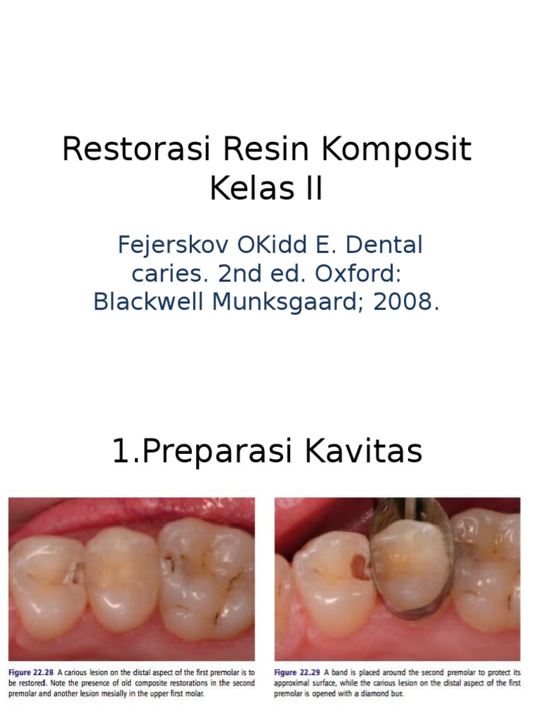 SOP Resin Komposit | PDF
