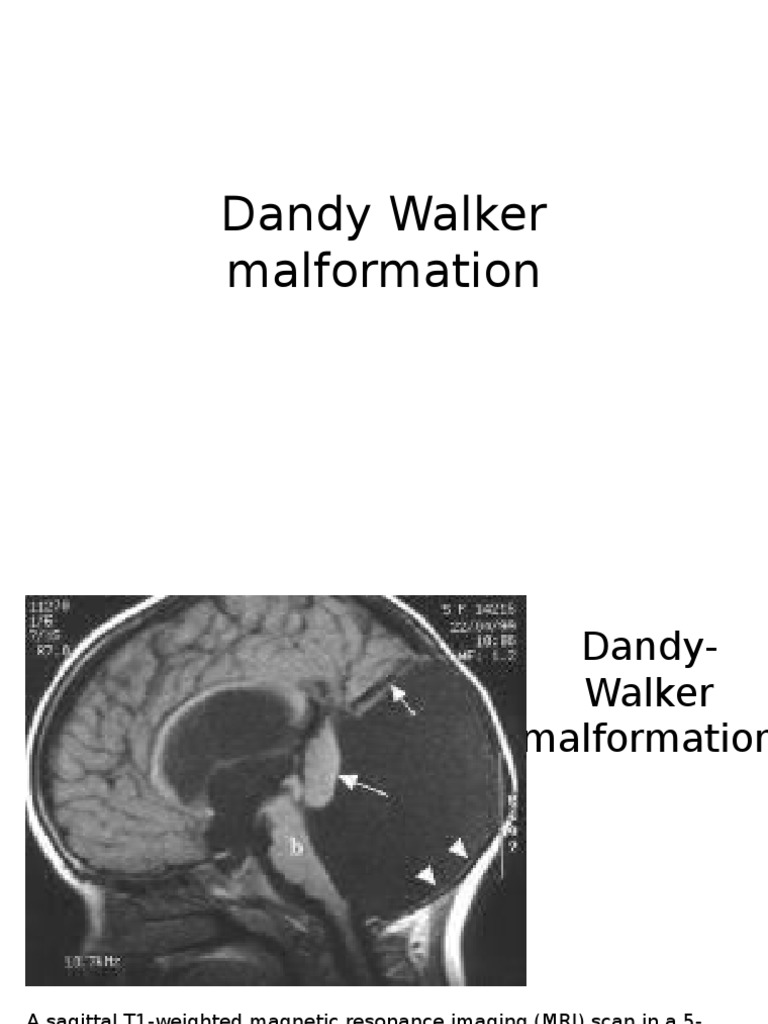 Dandy Walker Malformation | PDF
