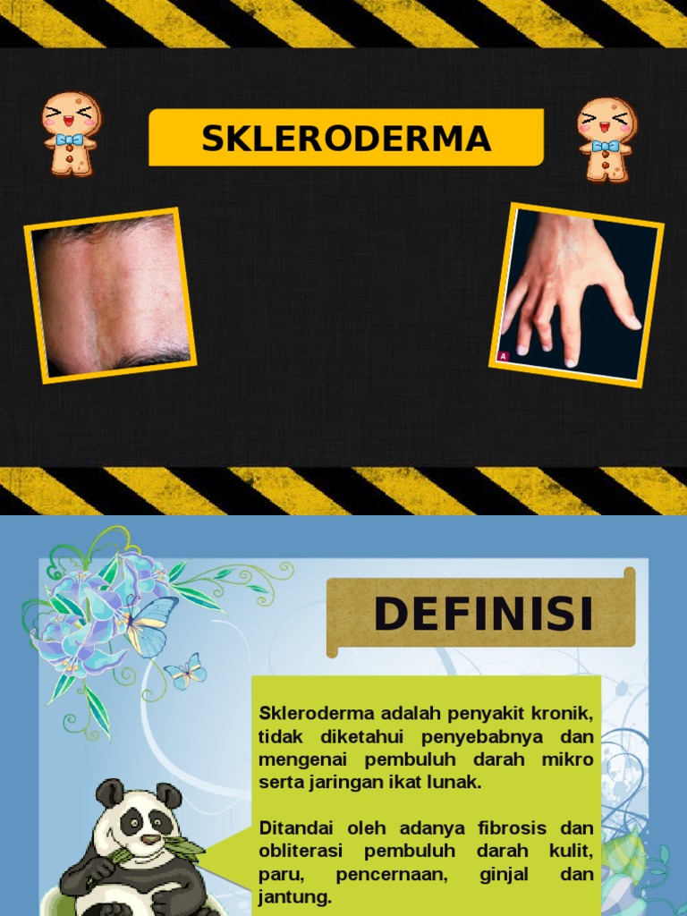 Patofisiologi Skleroderma | PDF