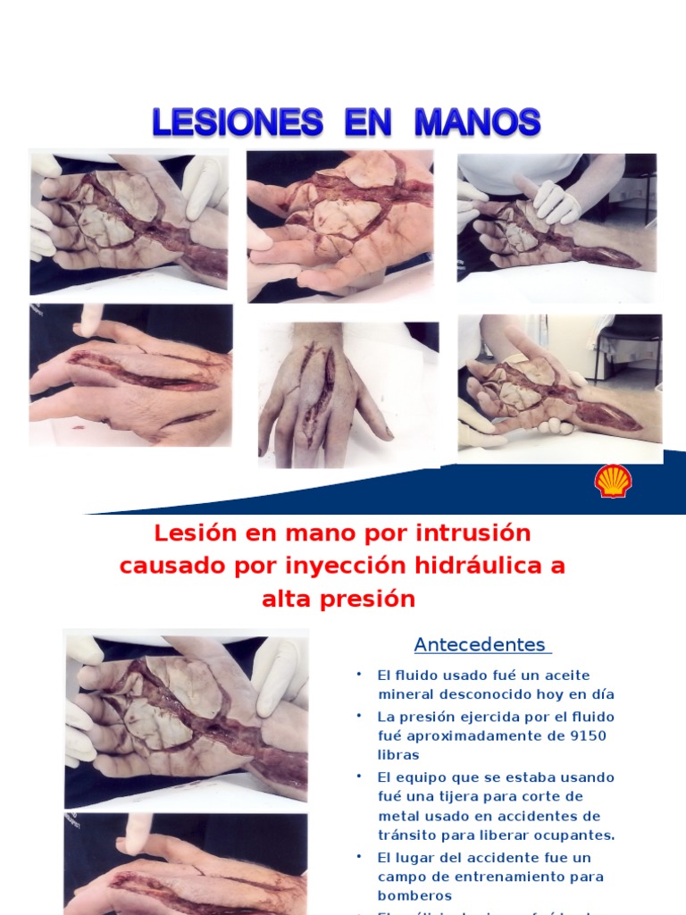 Lesión grave en mano por inyección hidráulica | PDF | Salud y bienestar ...