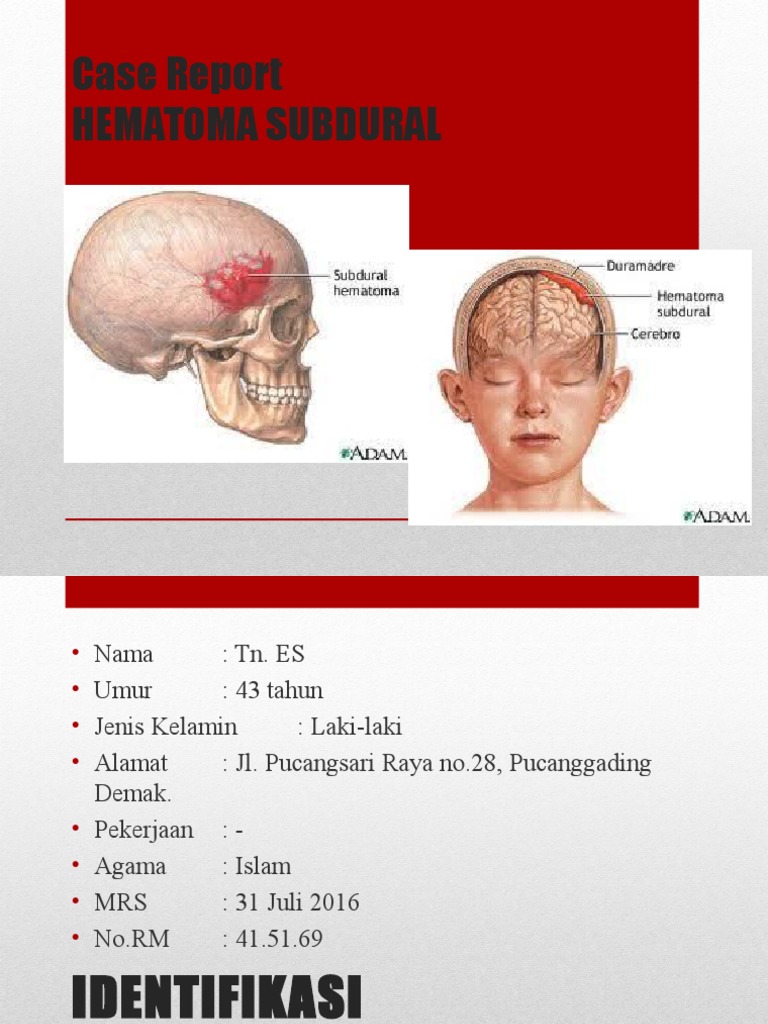 SDH Case Report | PDF