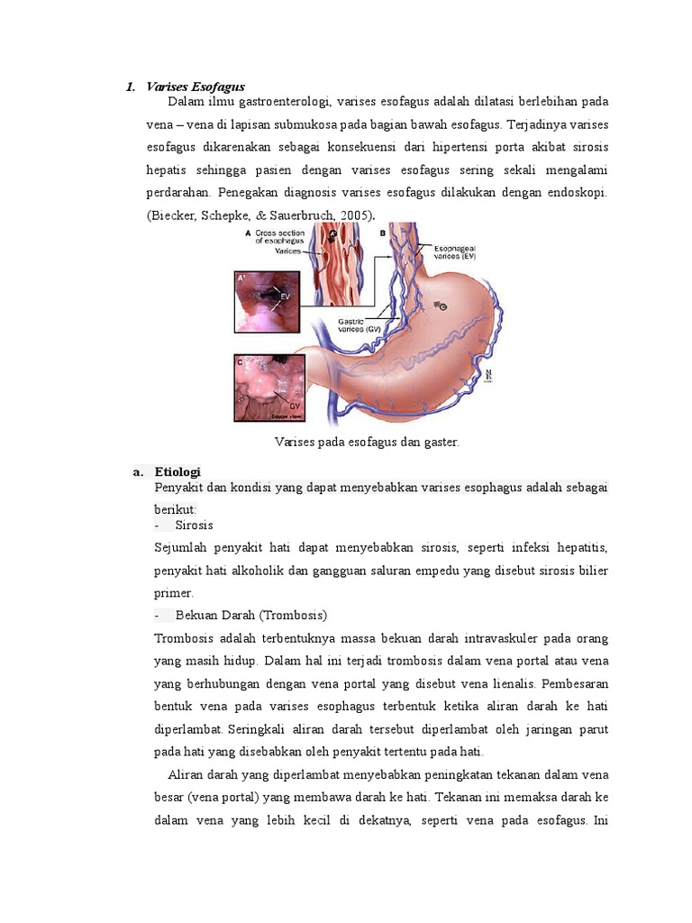 VARICES ESOFAGUS: PENYEBAB, GEJALA KLINIS, DAN PENANGANANNYA | PDF