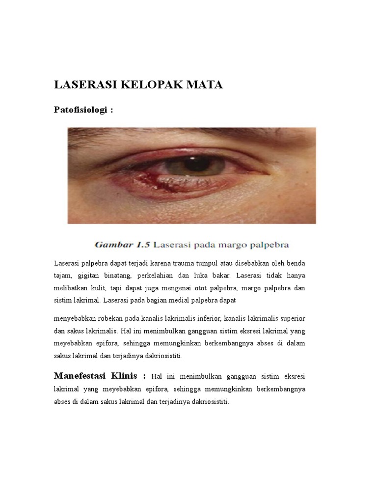 Laserasi Kelopak Mata | PDF