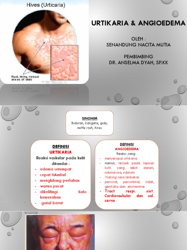 Urtikaria dan Angioedema | PDF